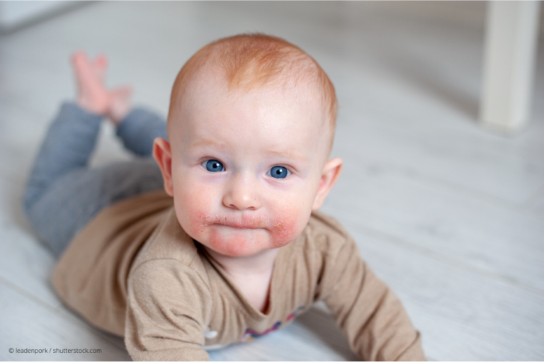 Neurodermitis beim Baby: Alles was Du wissen musst – Eltern.me